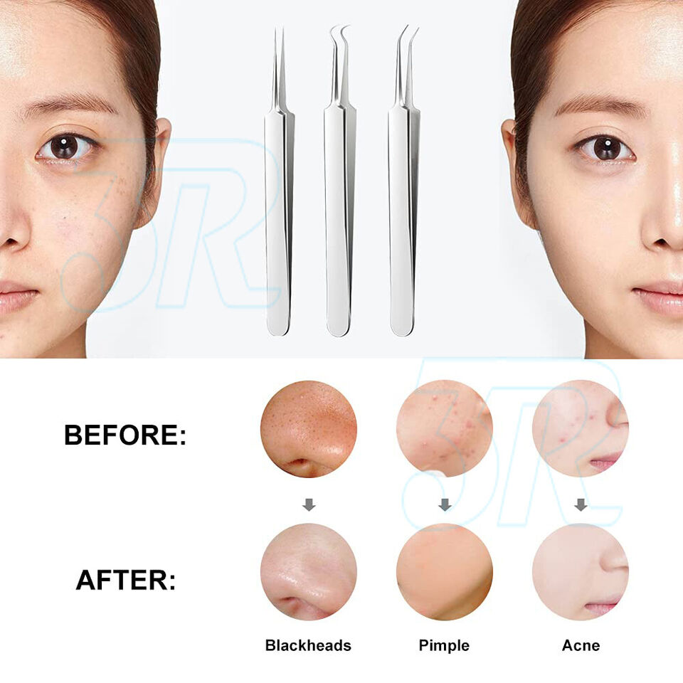 Blackhead Remover Spot Acne Pimple Extractor Tweezer Facial Tool Profe